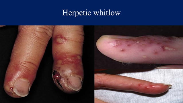 Acute multiple Oral ulcers | PPTX