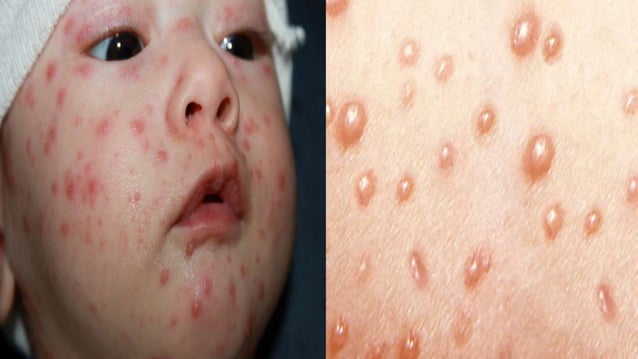 Acute multiple Oral ulcers | PPTX