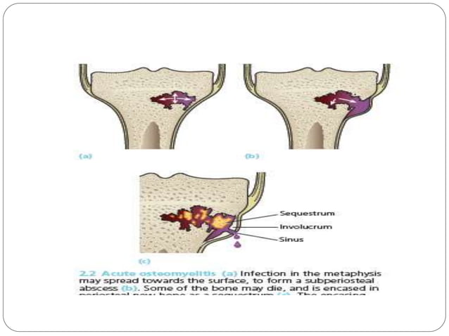 Acute musculoskeletal infections in children | PPT