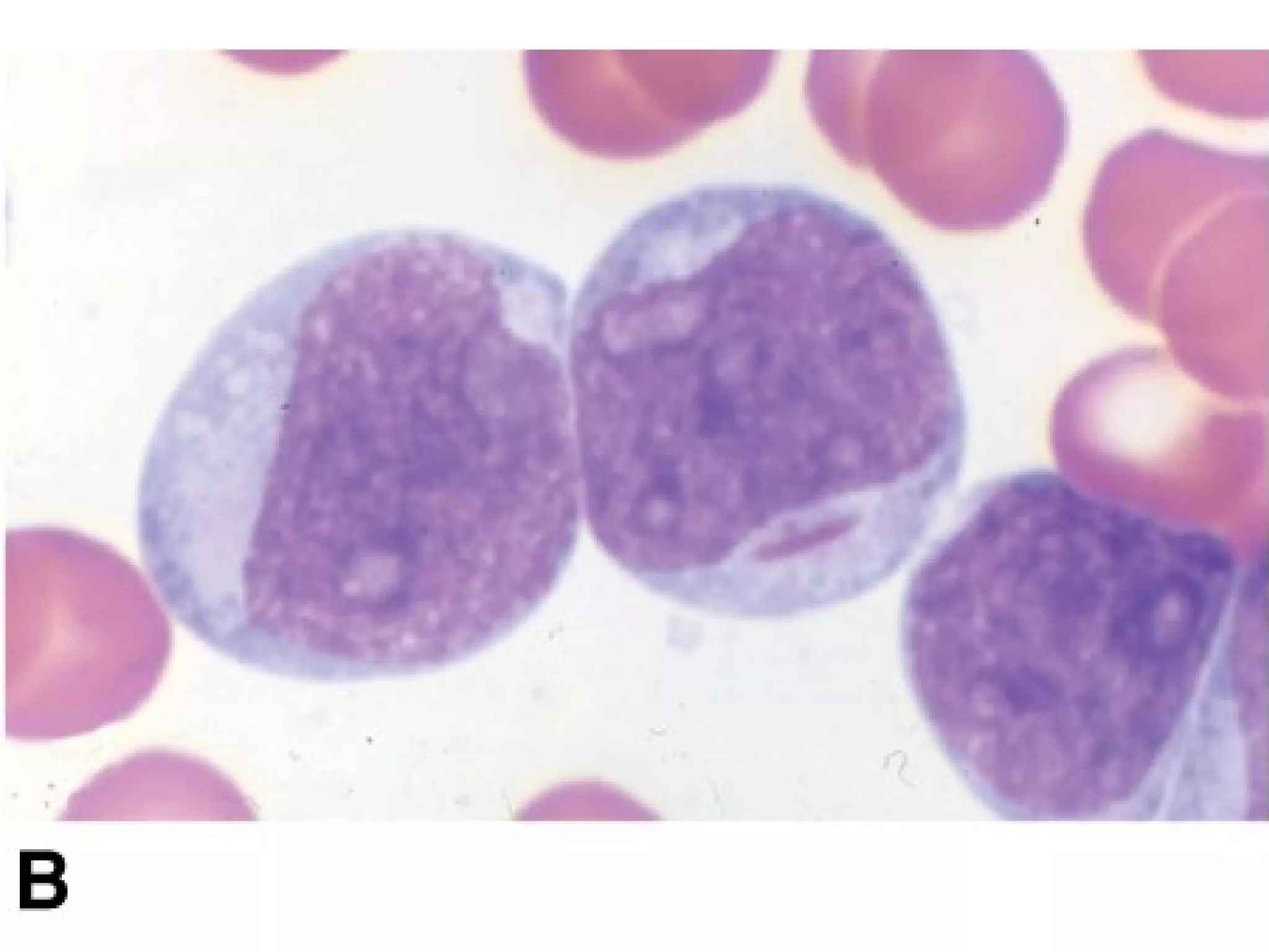 Acute Myelogenous Leukaemia | PPT