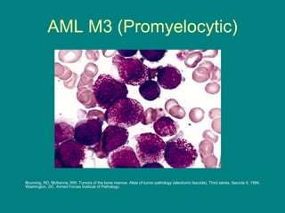 Acute Myeloid Leukemia | PPT