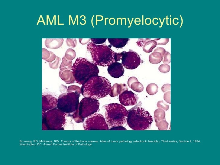 Leukemia Promyelocytic Acute Leukemia Myeloid Acute M3 Leukemia
