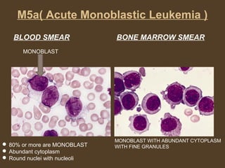 Acute myeloid leukemia | PPT
