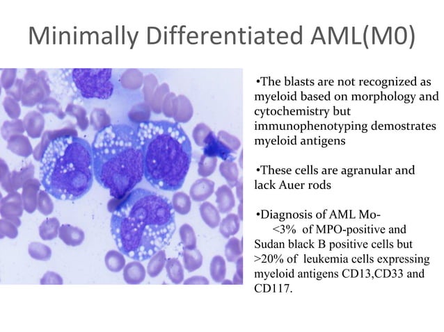 Acute myeloid leukemia | PPT