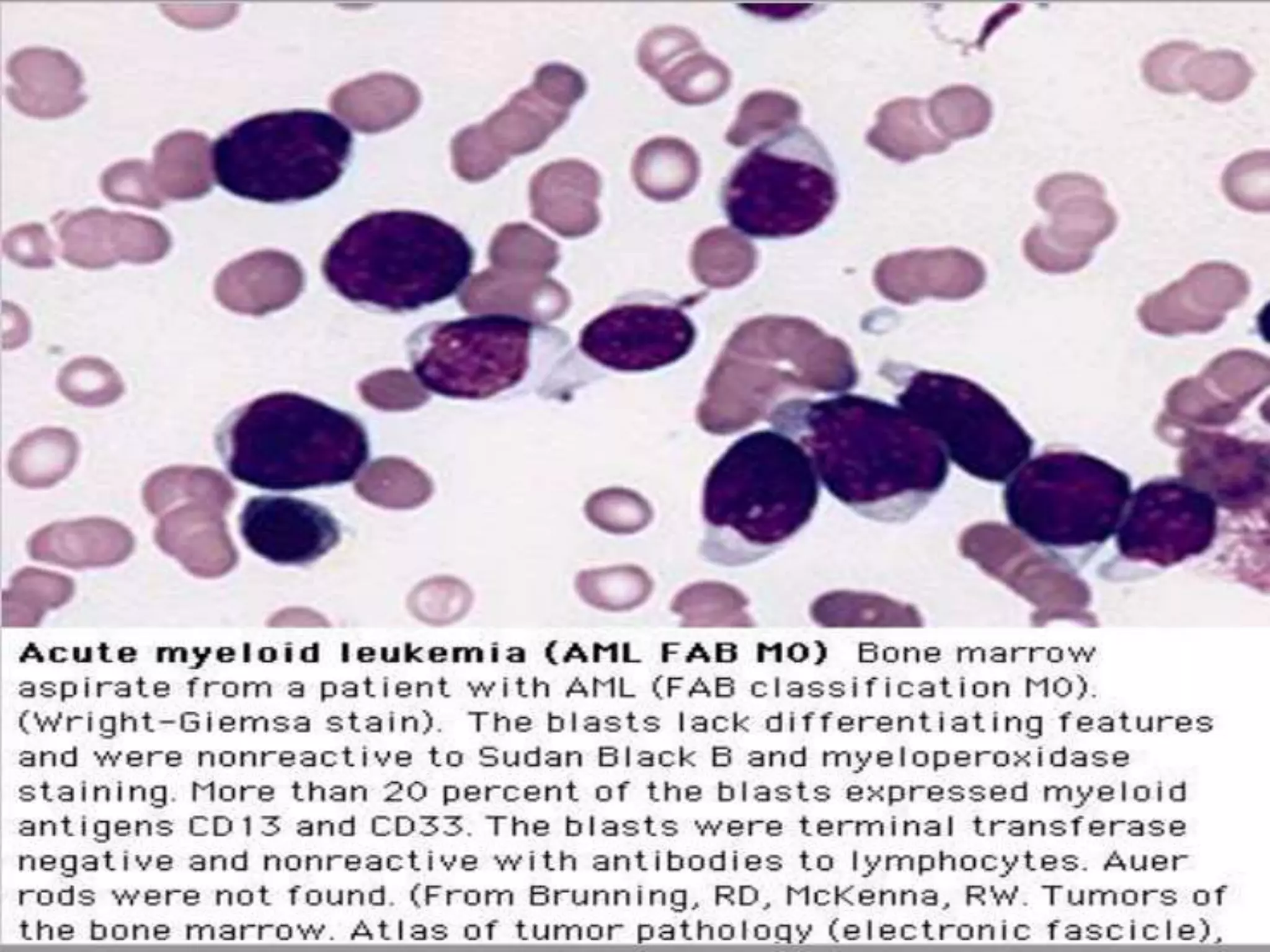 Acute Myeloid Leukemia | PPT