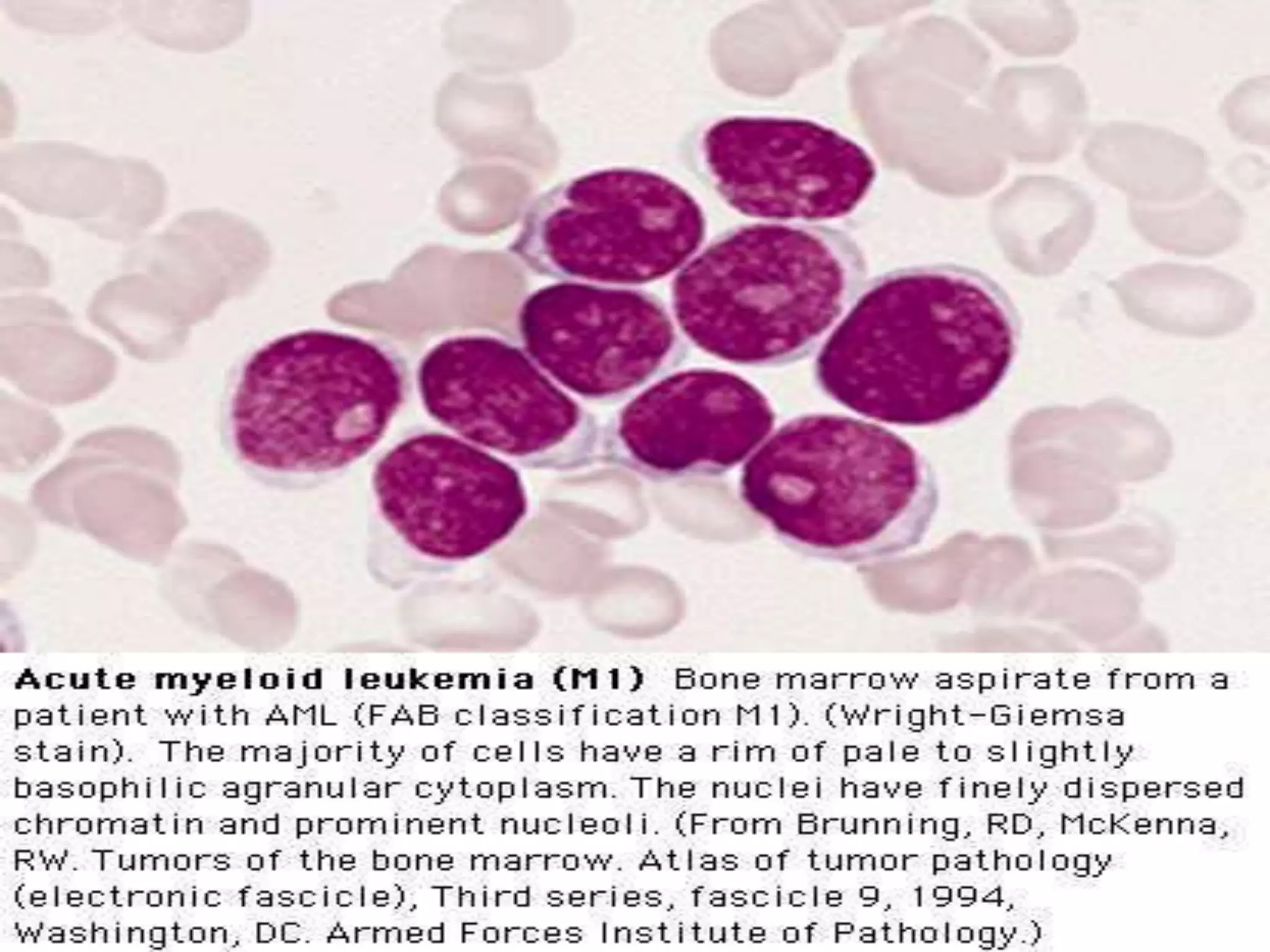 Acute Myeloid Leukemia | PPT