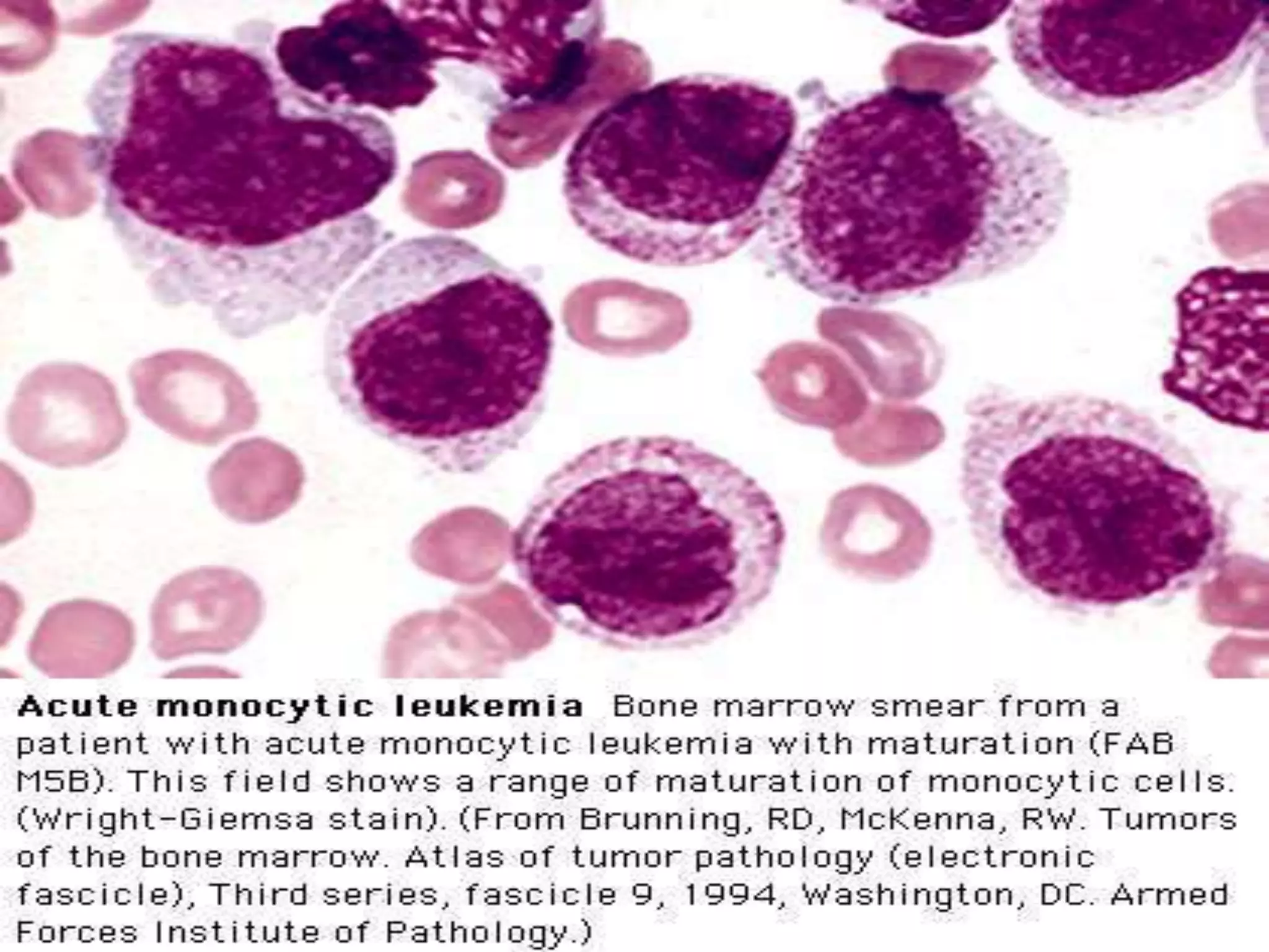 Acute Myeloid Leukemia | PPT