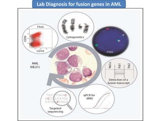Acute Myeloid Leukemia | PPTX