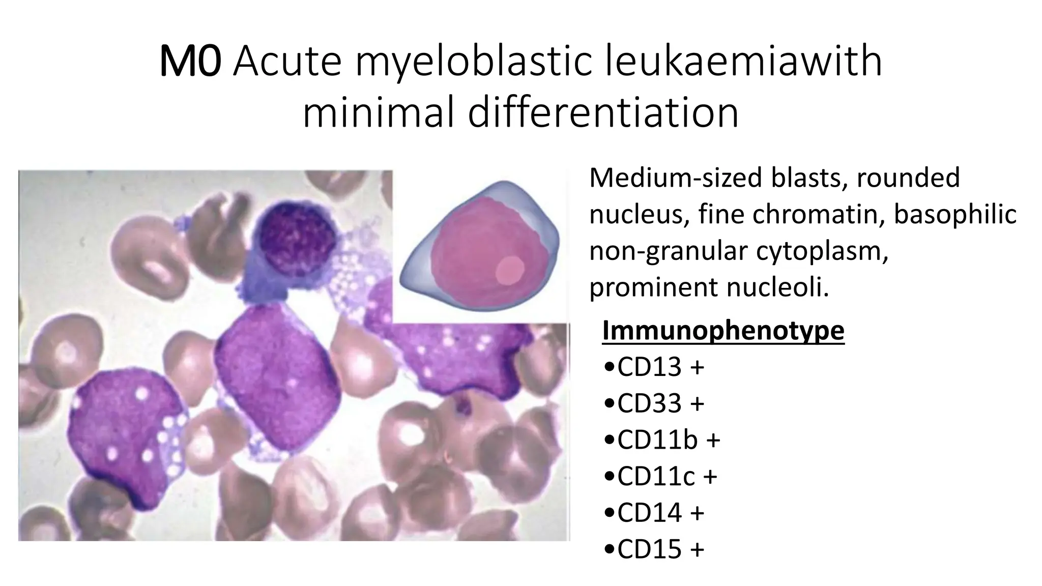 ACUTE MYELOID LEUKEMIA.pptx