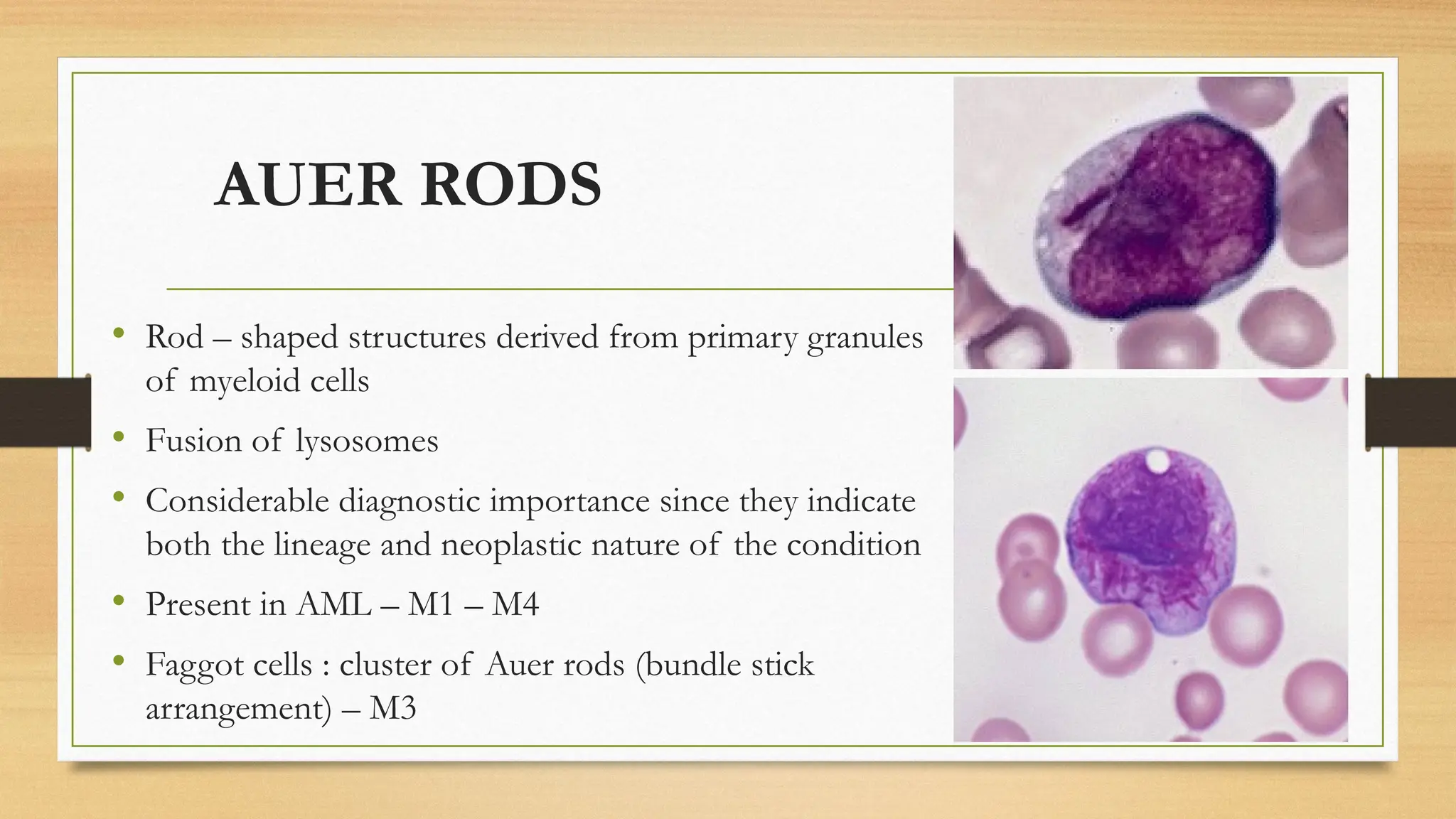 ACUTE MYELOID LEUKEMIA PPT .presentstion | PPTX