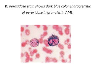 Acute Myeloid Leukemia(AML).pptx