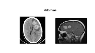 ACUTE MYELOID LEUKEMIA IN CHILDREN- Etiology, Diagnosis and Management ...