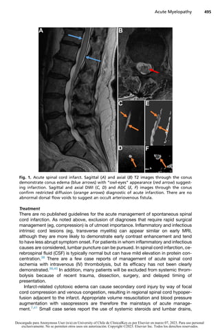 Acute Myelopathy- Vascular and Infectious Diseases.pdf