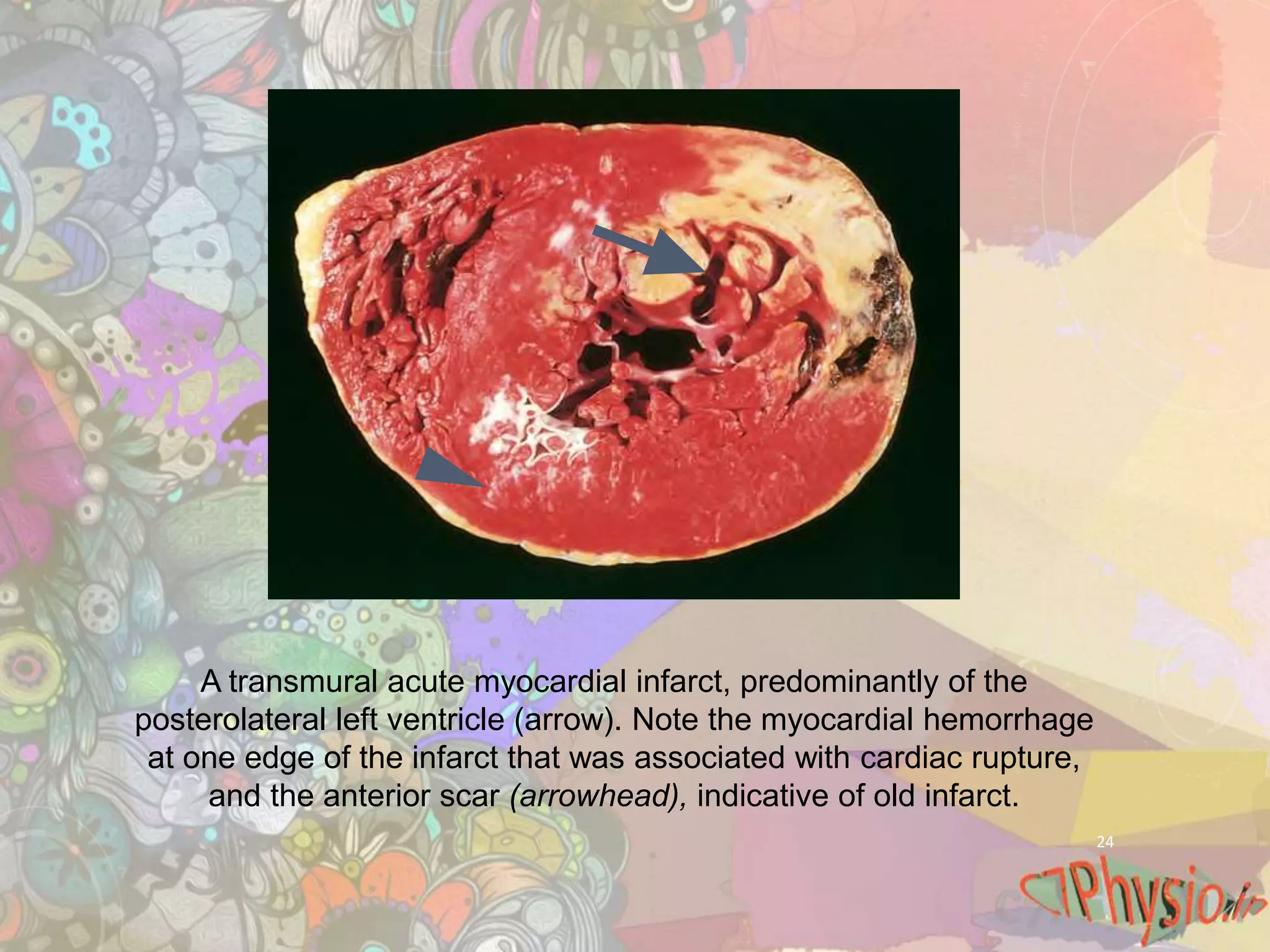 Acute myocardial Infarction | PPTX