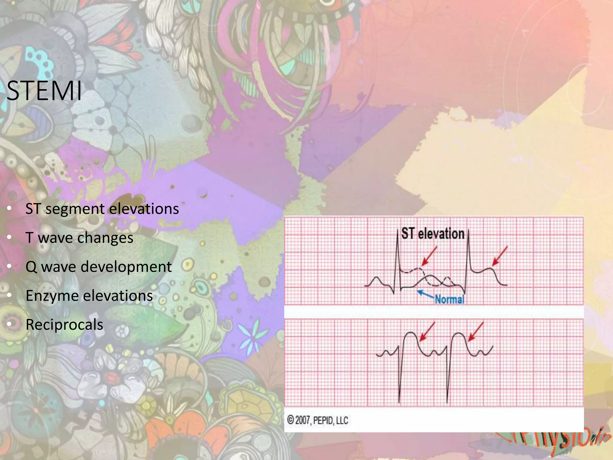 Acute myocardial Infarction | PPTX