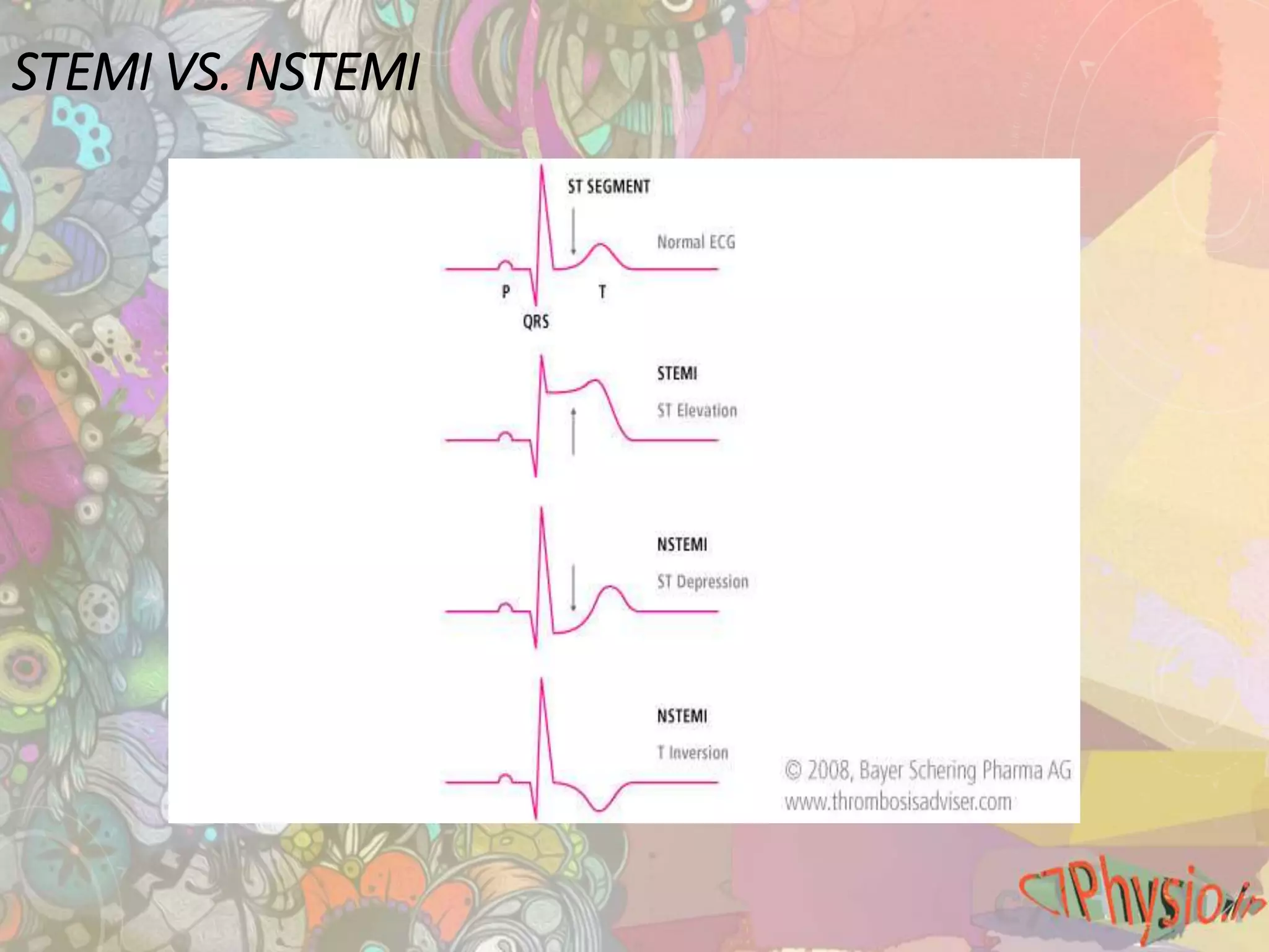 Acute myocardial Infarction | PPTX