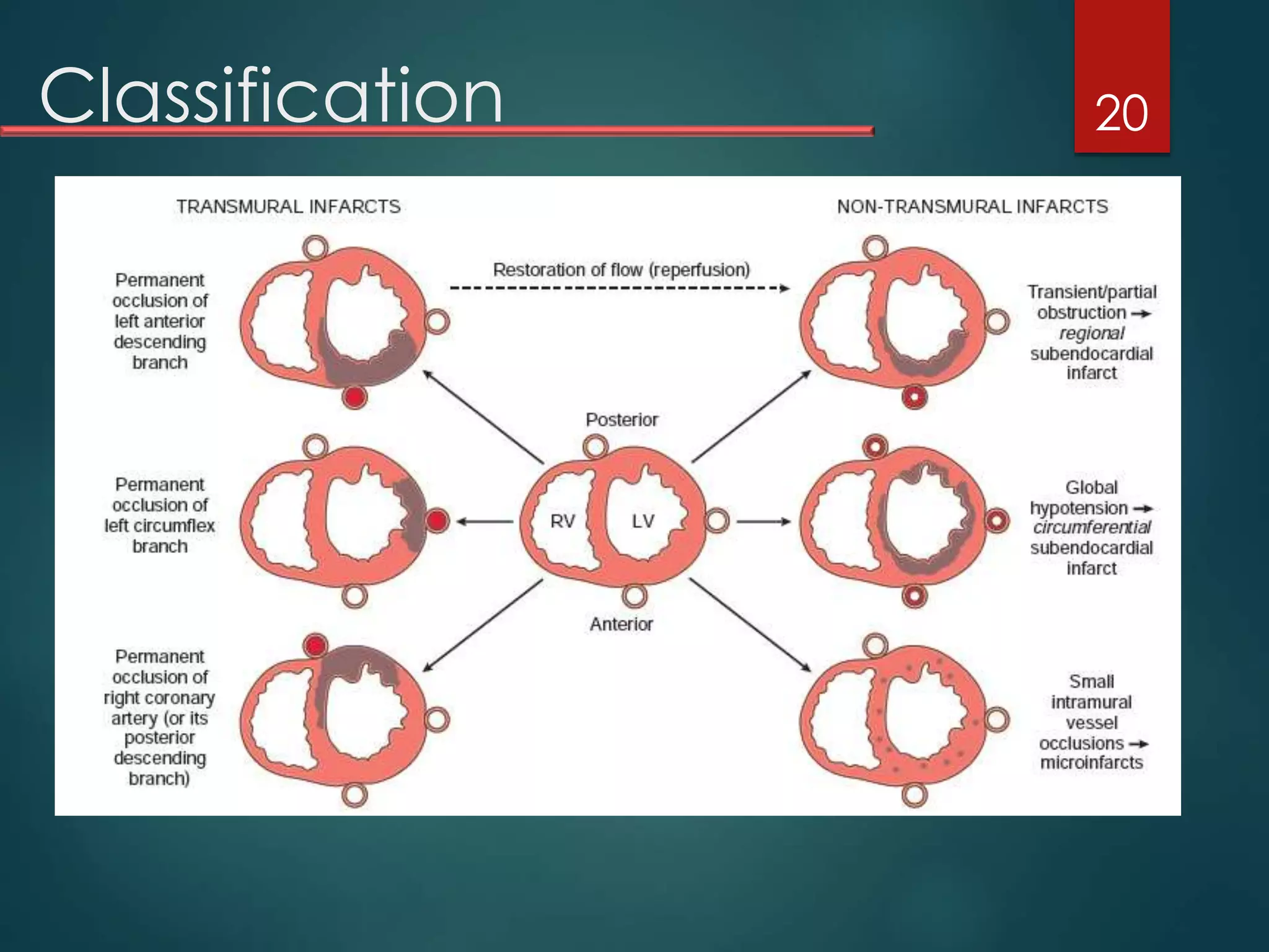Acute Myocardial Infarction | PPTX