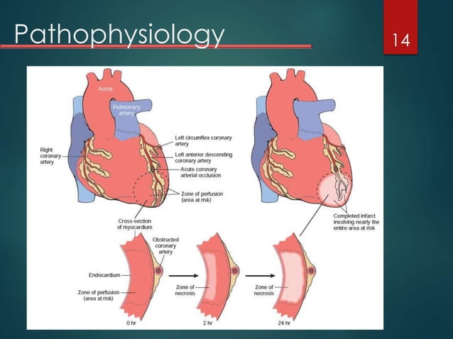 Acute Myocardial Infarction | PPTX