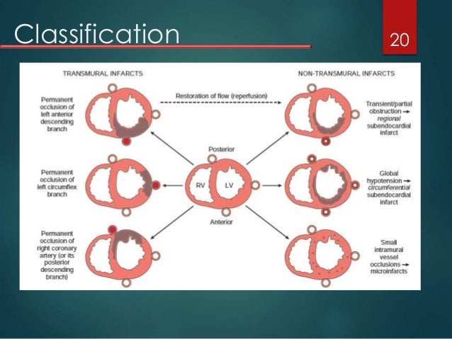 Acute Myocardial Infarction
