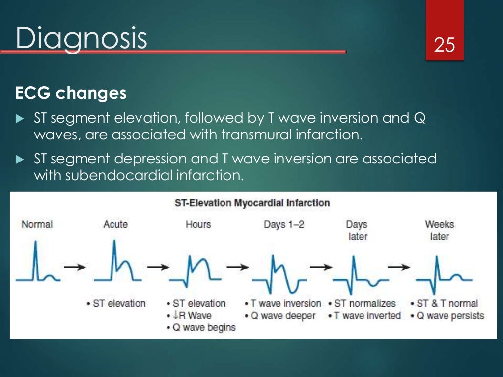 Acute Myocardial Infarction