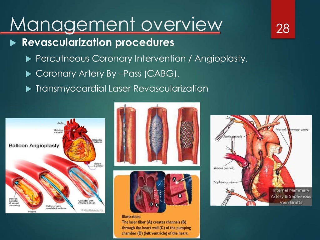 Acute Myocardial Infarction