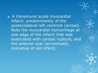 Acute Myocardial Infarction | PDF