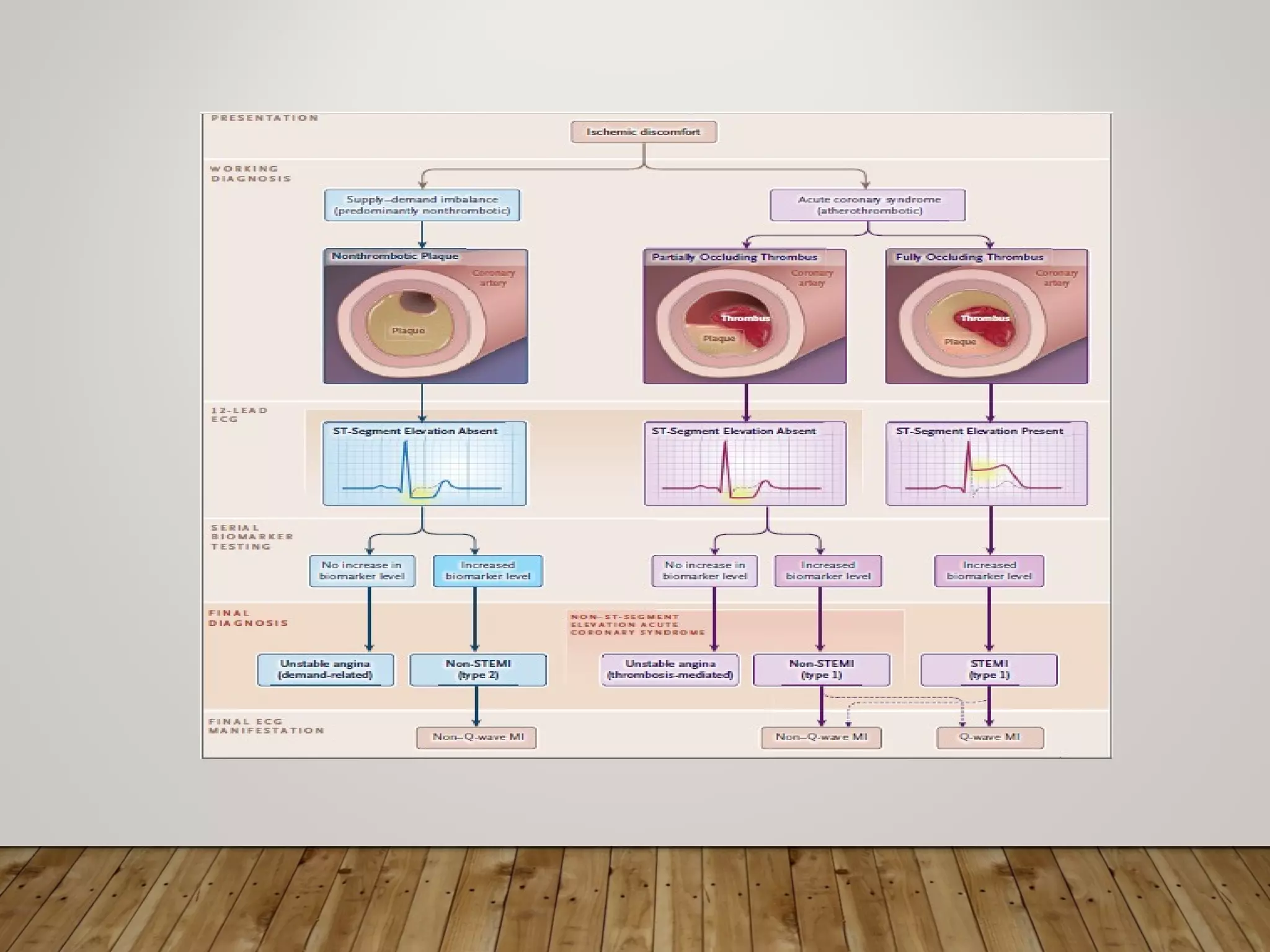 Acute myocardial infarction | PPT