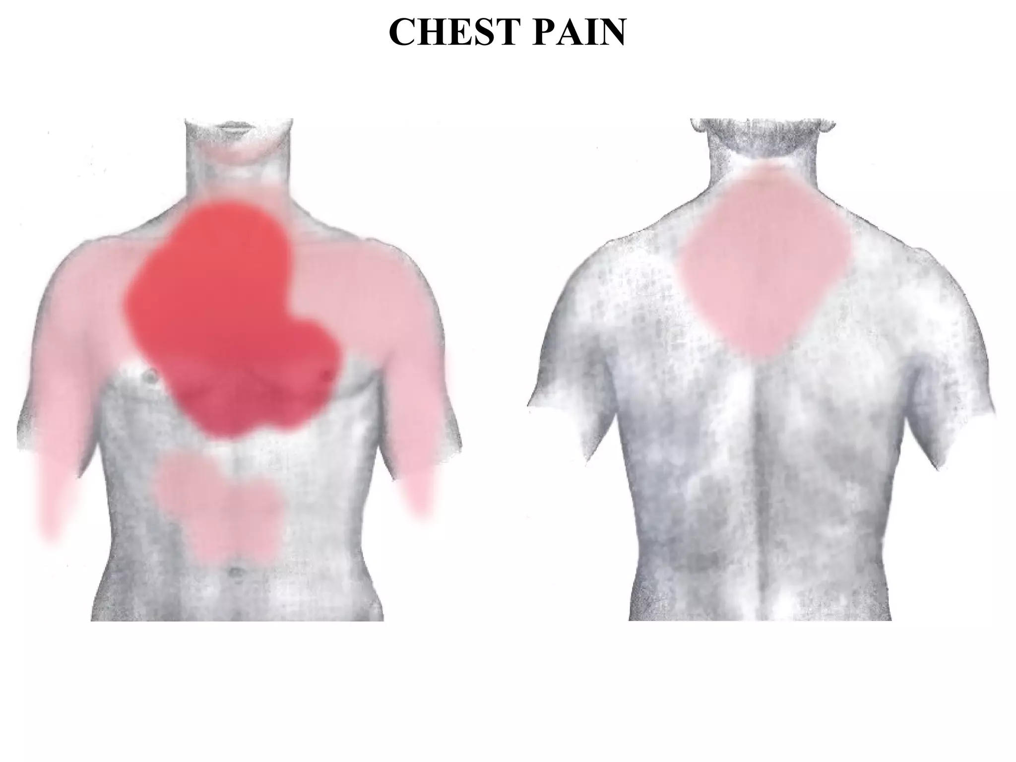 Acute myocardial infarction | PPT