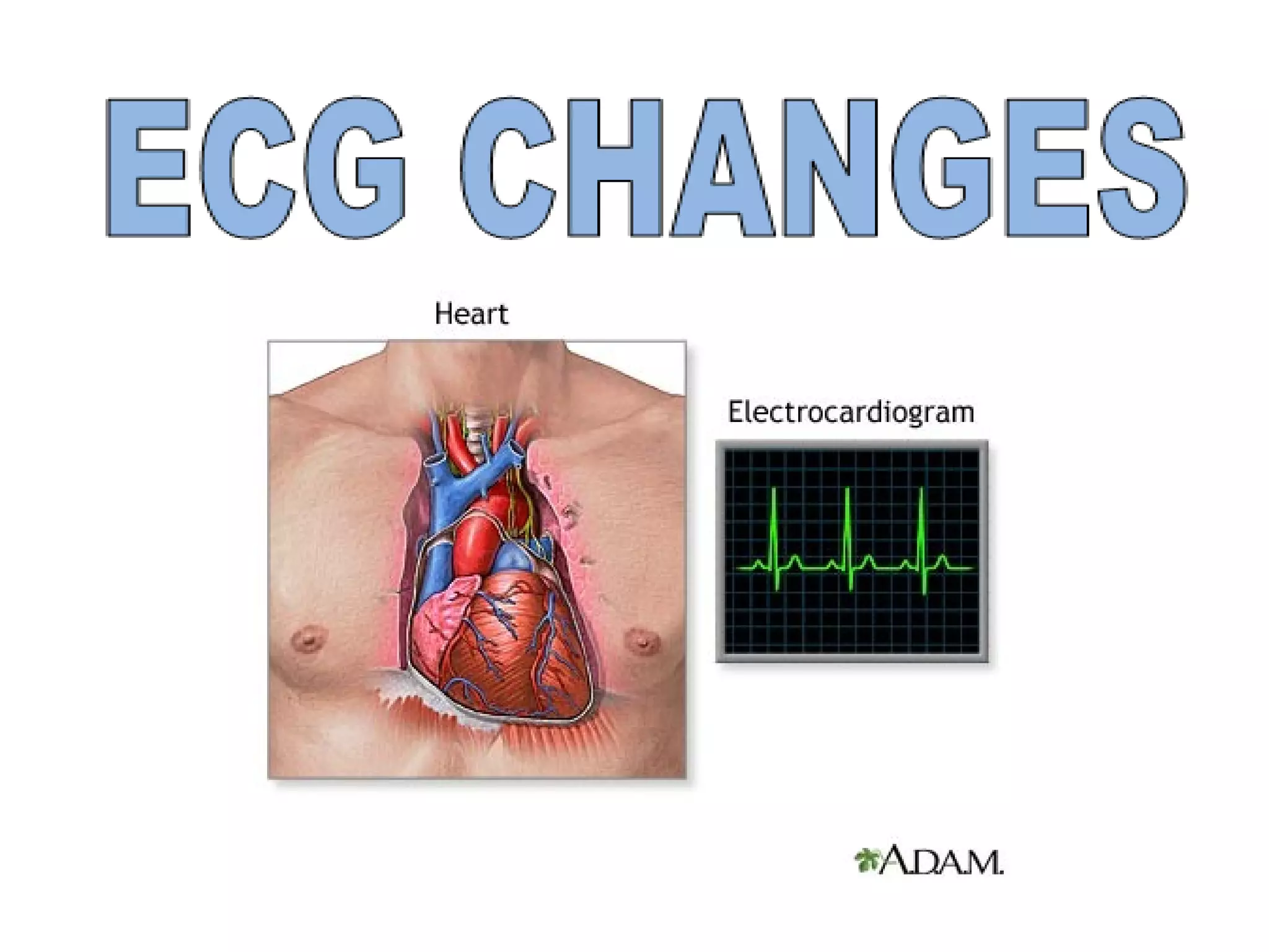 Acute myocardial infarction | PPT