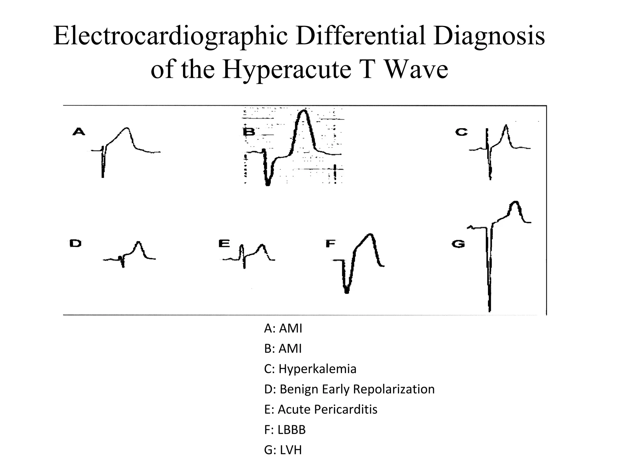 Acute myocardial infarction | PPT