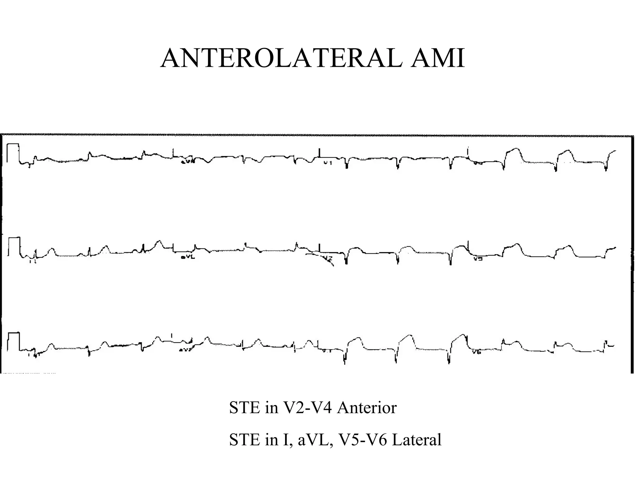 Acute myocardial infarction | PPT