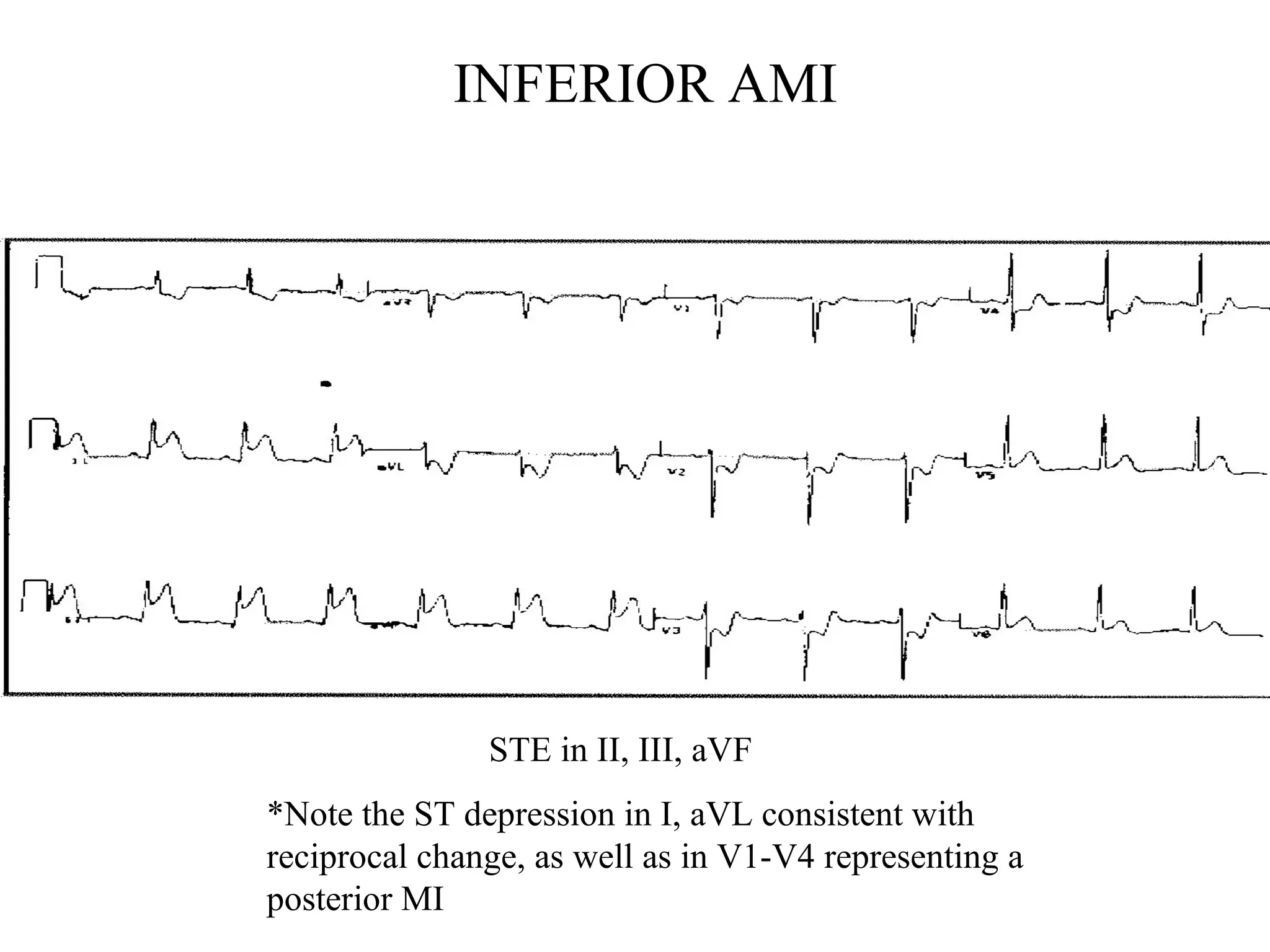 Acute myocardial infarction | PPT