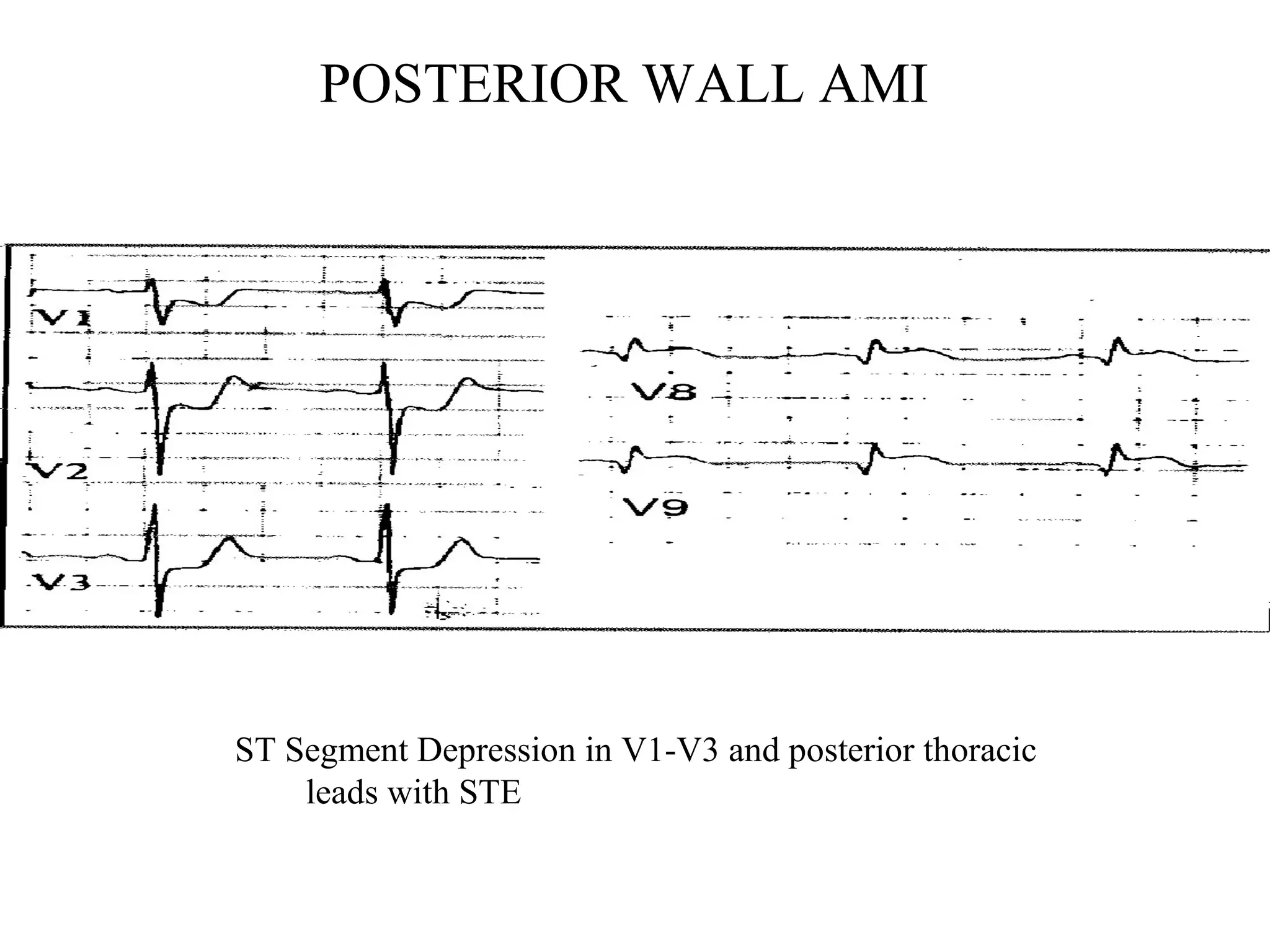 Acute myocardial infarction | PPT