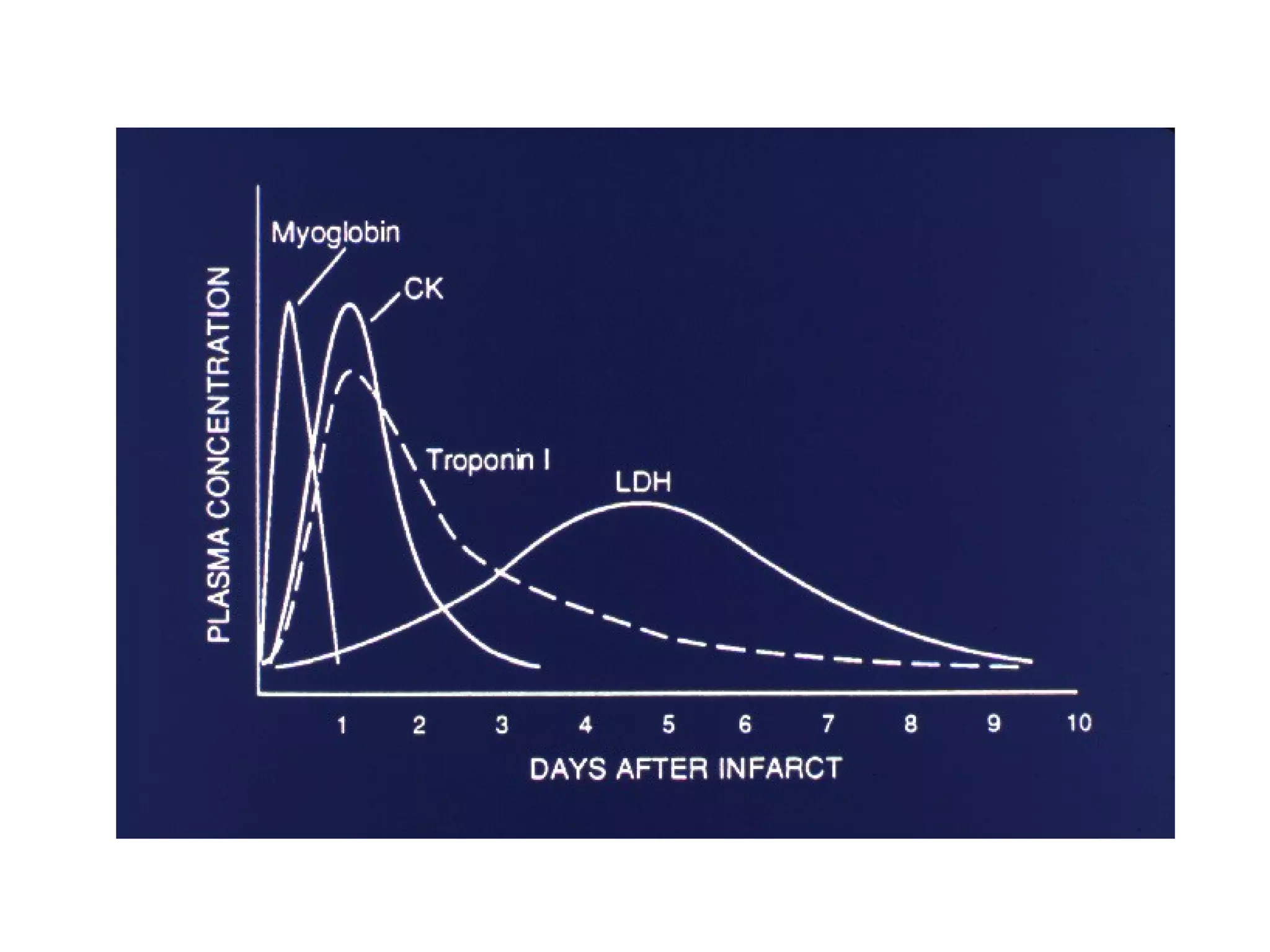 Acute Myocardial Infarction Ppt