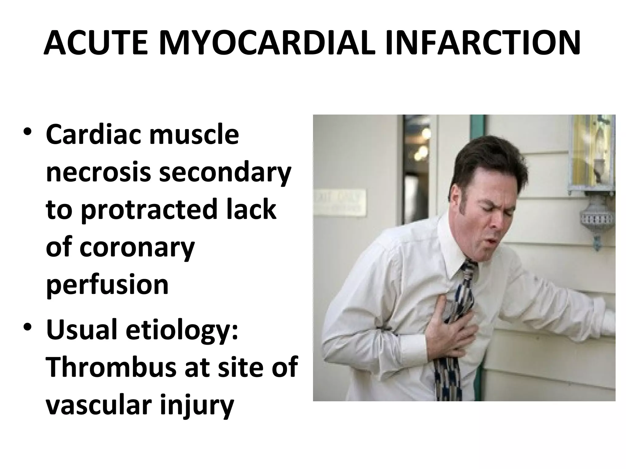 Acute myocardial infarction | PPT