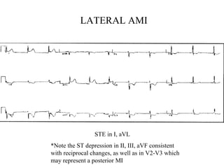 Acute myocardial infarction | PPT