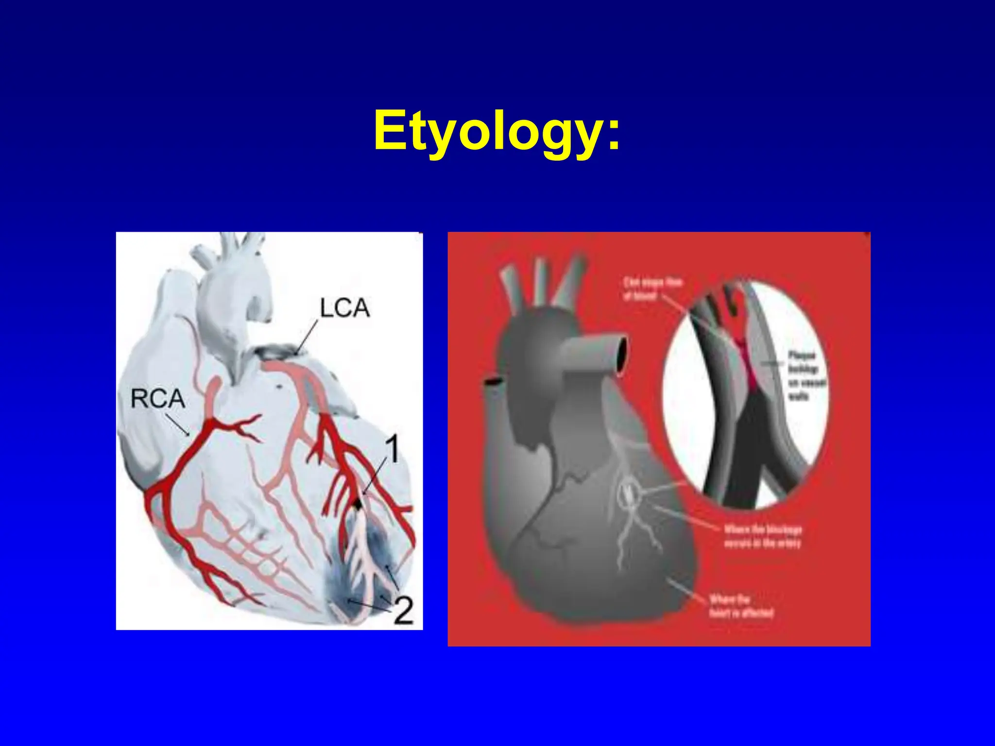 Acute coronary syndrome. Diagnosis, treatment and prophylaxis of ...
