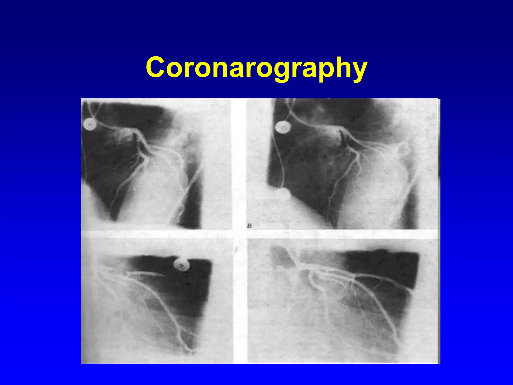 Acute coronary syndrome. Diagnosis, treatment and prophylaxis of ...
