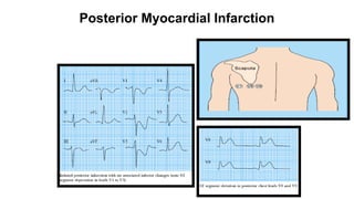 Acute Myocardial Infarction Infarction.pptx