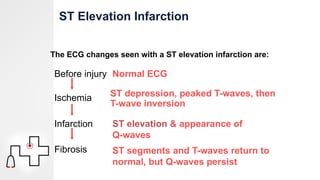 Acute Myocardial Infarction Infarction.pptx