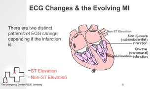 Acute Myocardial Infarction Infarction.pptx