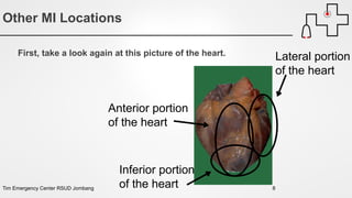 Acute Myocardial Infarction Infarction.pptx
