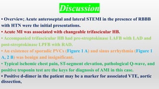 Acute myocardial infarction associated with right bundle branch block ...