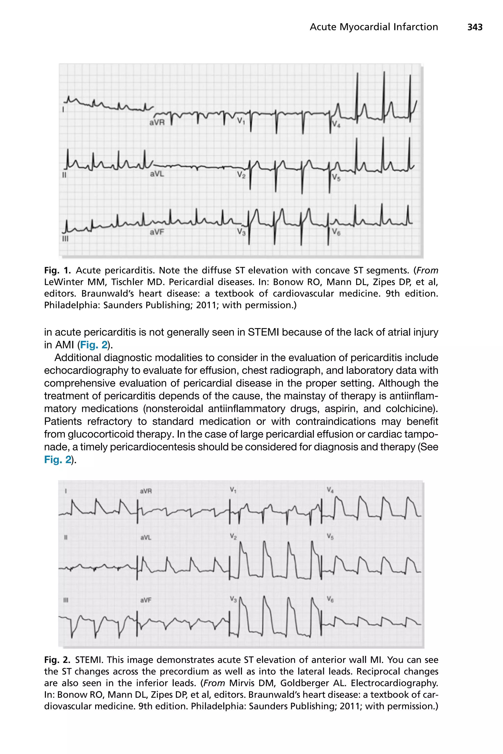 Acute myocardial infarction critical care cardiology | PDF