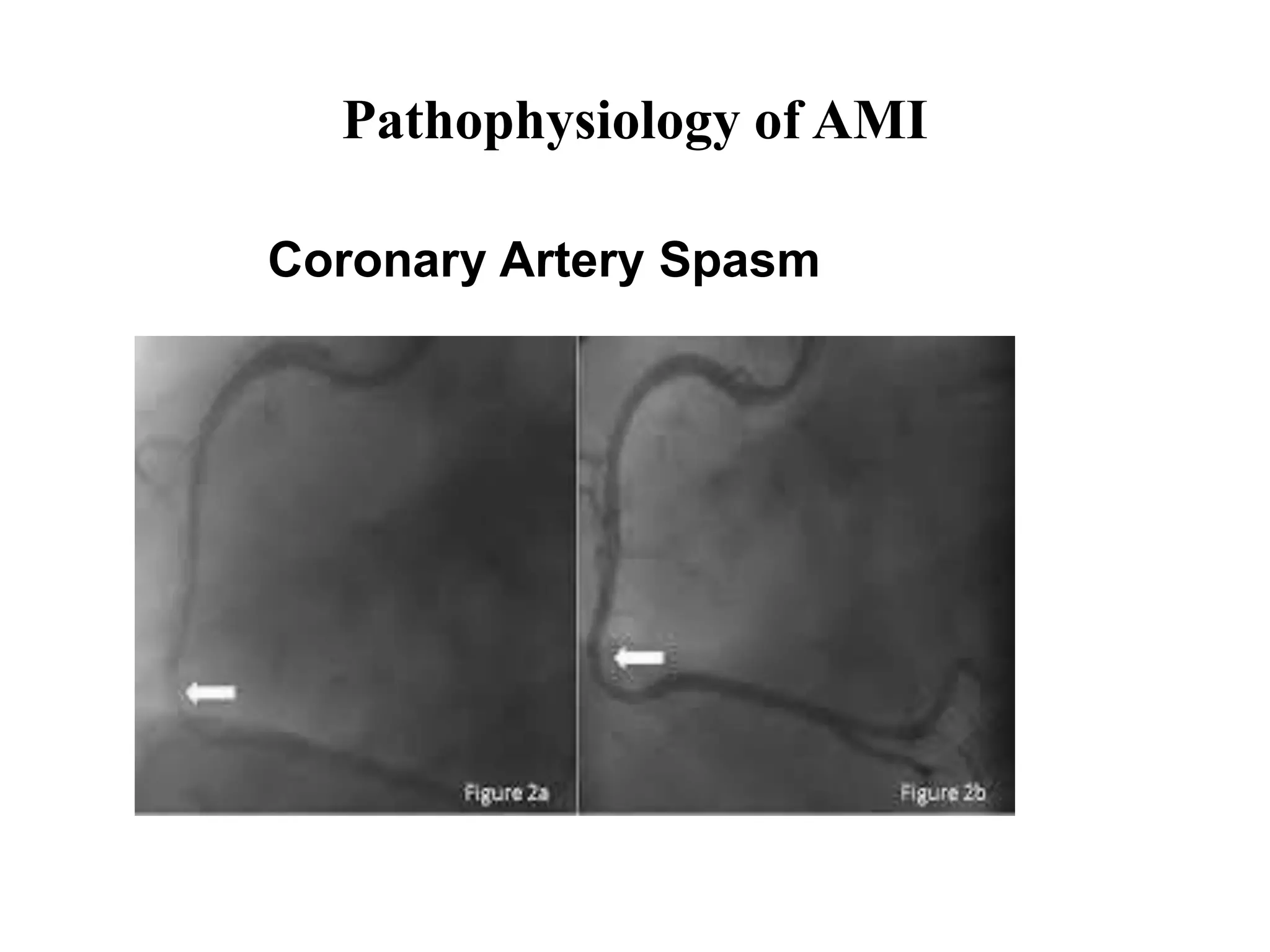 Acute myocardial infarction in women | PPT