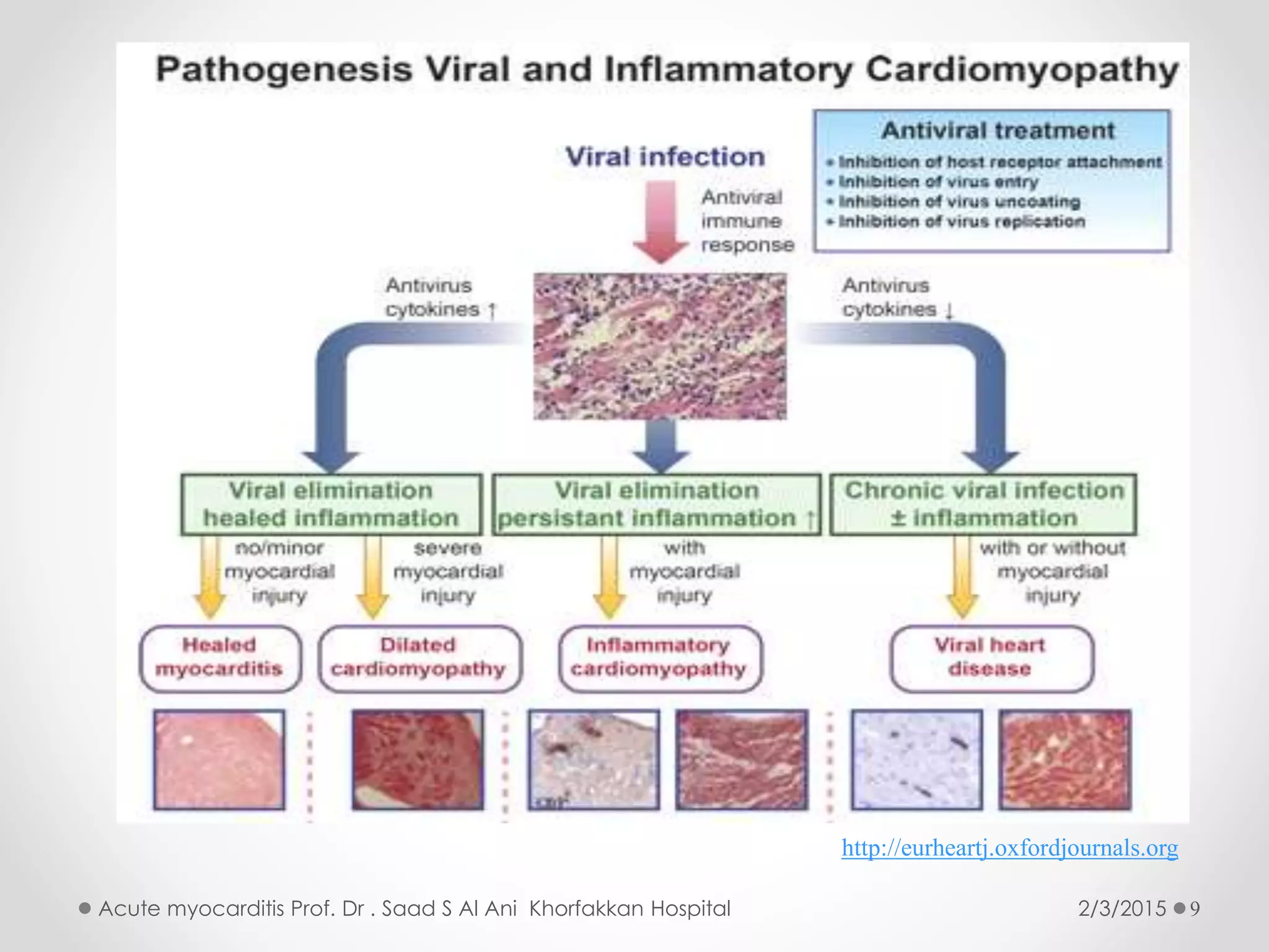Acute viral myocarditis | PPTX