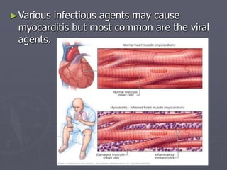 Acute myocarditis - Dr.vikash kumar, BSMU | PPT