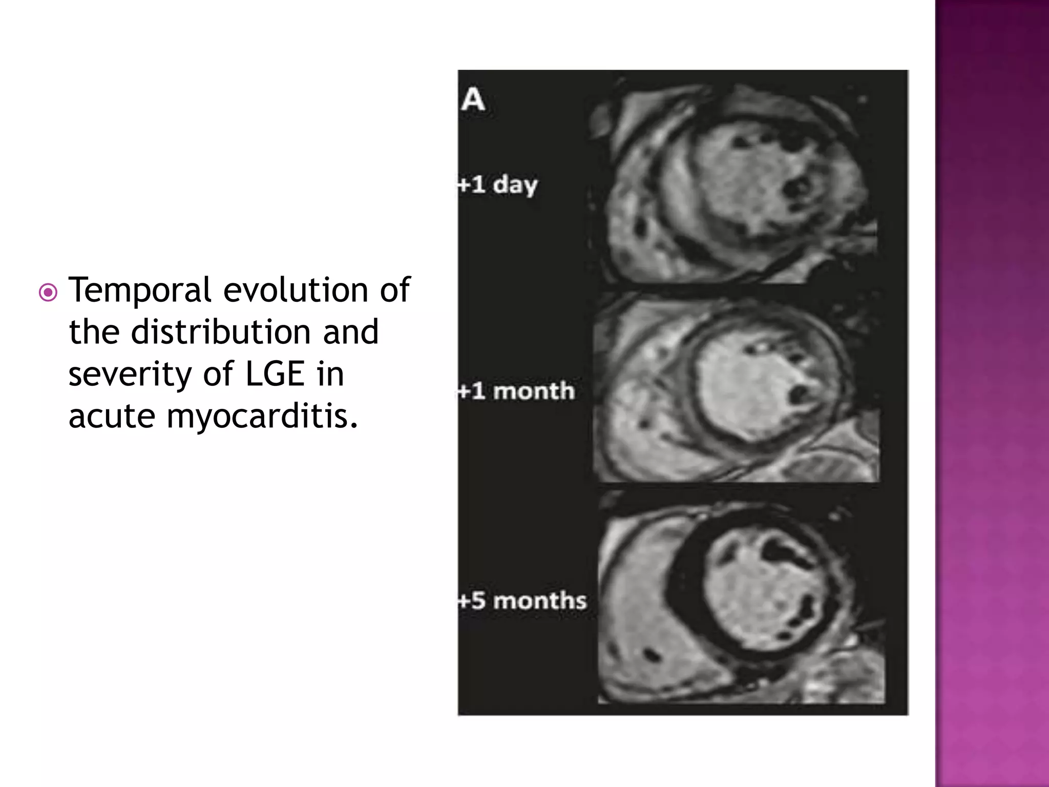 Acute Myocarditis:Diagnosis and Management | PPTX