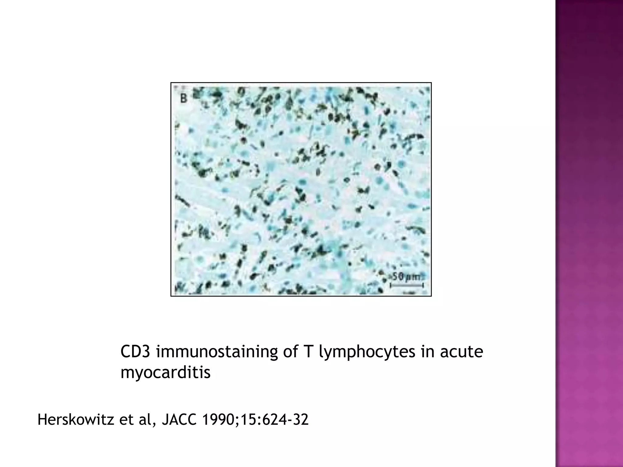 Acute Myocarditis:Diagnosis and Management | PPTX