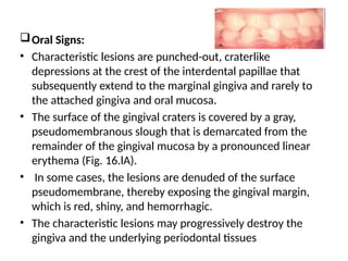ACUTE NECROTIZING ULCERATIVE GINGIVITIS-1.pptx